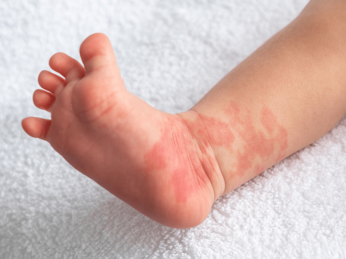 Newborn Rashes - Academic Alliance in Dermatology